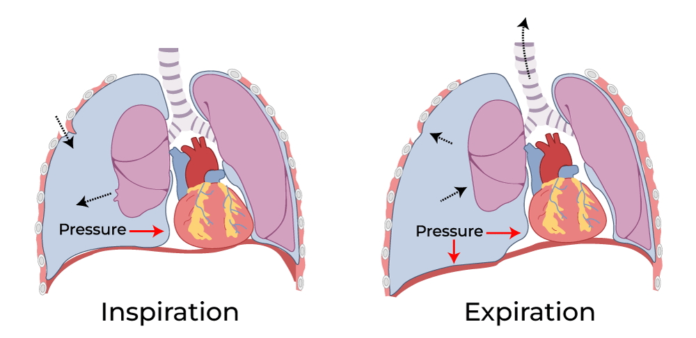 Quick, basic primer🧵- Decompressing a tension pneumothorax A tension ...