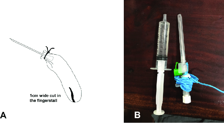 Quick, basic primer🧵- Decompressing a tension pneumothorax A tension ...
