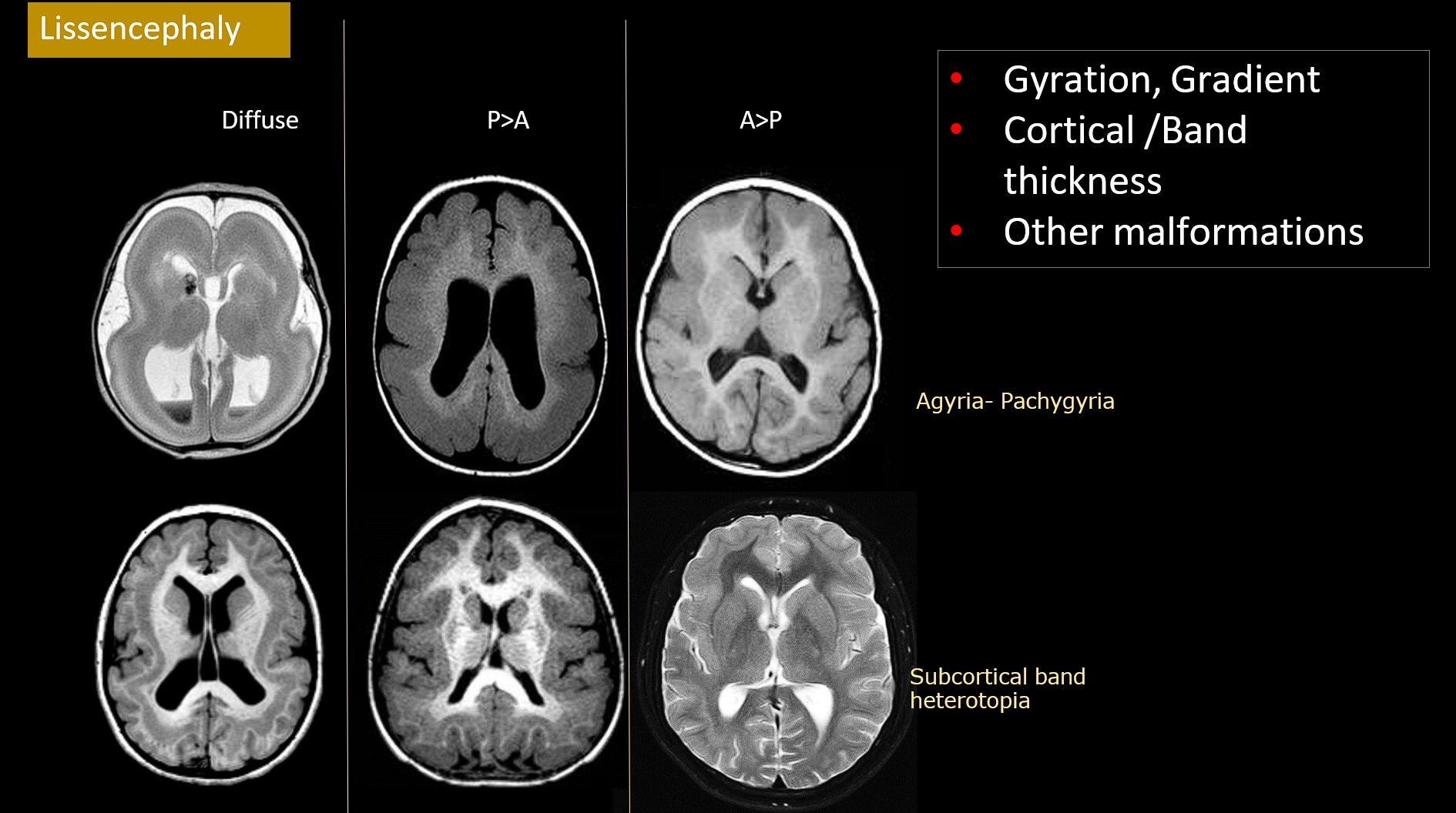 Lissencephaly Radiology Differences In The Gyral Pattern Distinguish