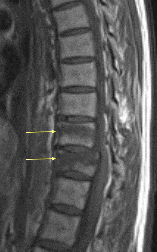 Distinguishing between pathologic & compression fractures can be ...