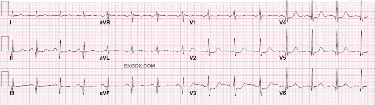 1/ Today's 🧵is about "STEMI Equivalents". The aim of this thread is to ...