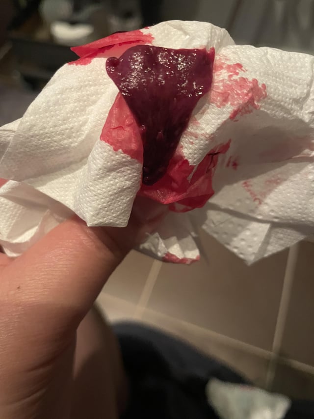 Decidual Bleeding How Much Blood Decidual Cast: Definition, Symptoms,