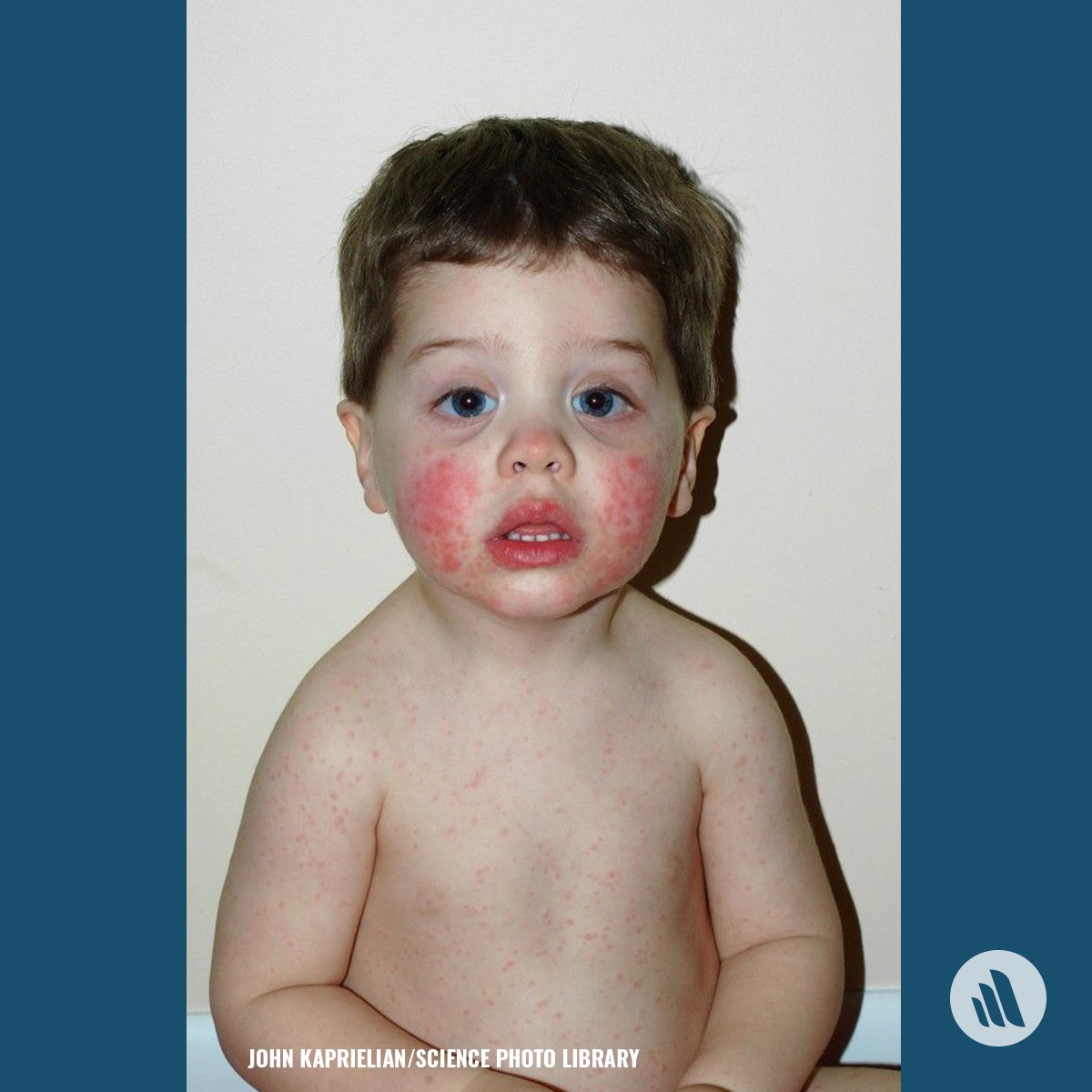 Erythema Infectiosum Parvovirus B19: CDC Warns Of New "slapped Cheek
