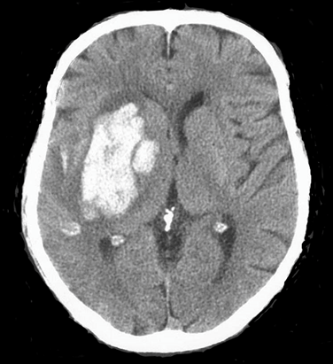 1/20 Interested in novel treatment approaches for deep ICH? Dive into ...