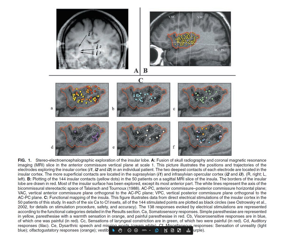 SEIZURE SEMIOLOGY #TWEETORIAL #Epilepsy #Seizure #NeuroX 🧵1/ What is ...