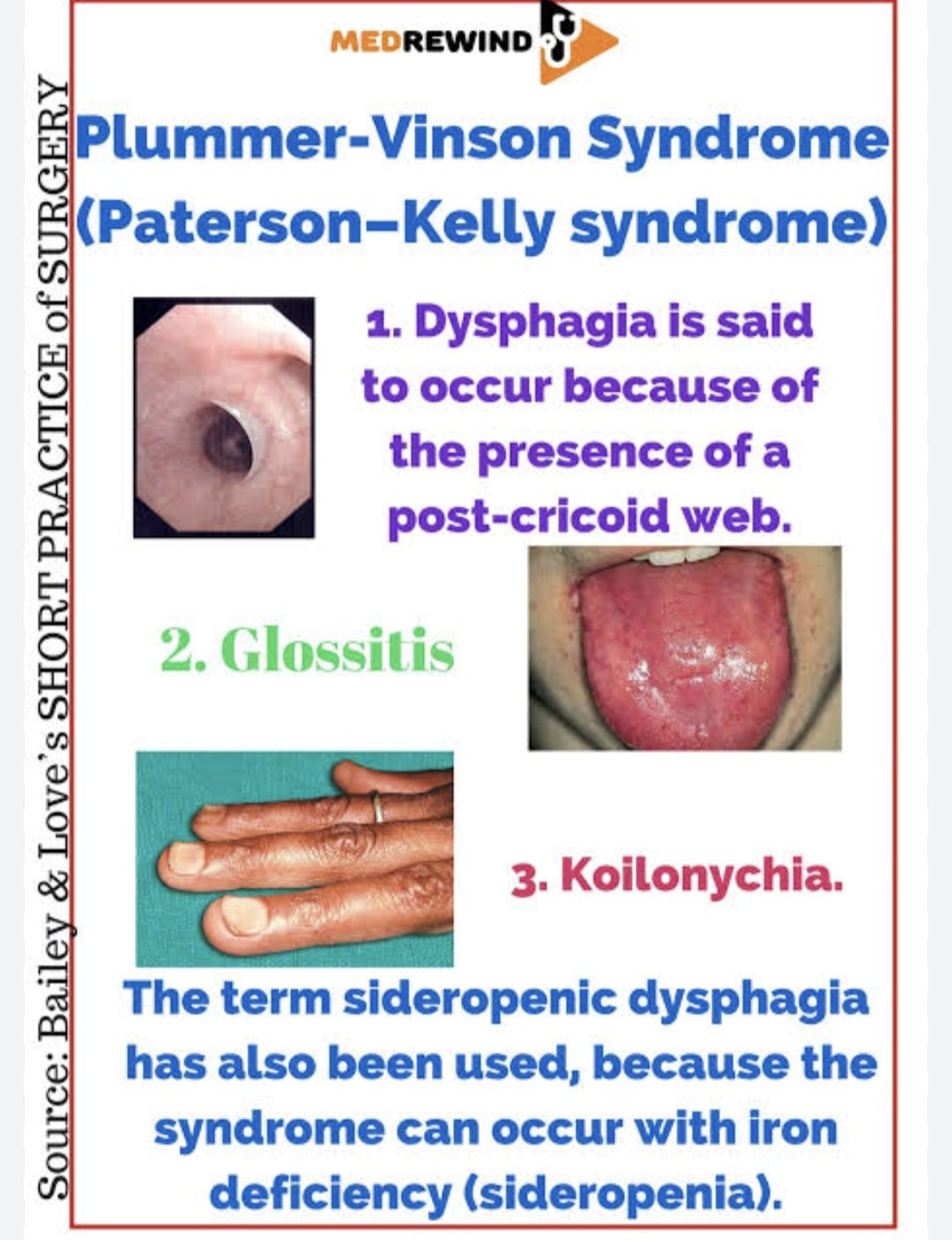 Paterson Kelly Syndrome