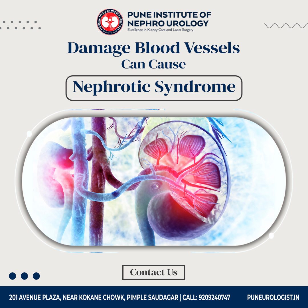 Pune Institute Of Nephro Urology (@pune_institute) / Posts / X