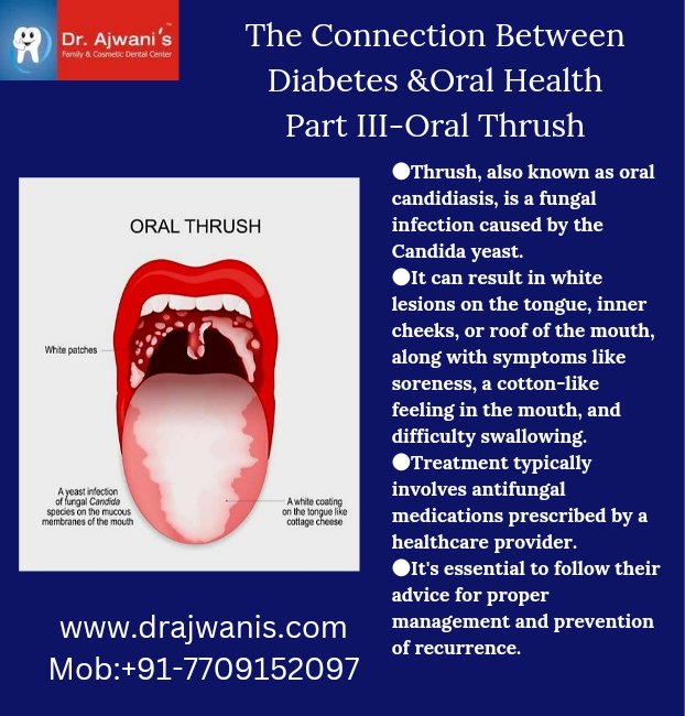 Normal Tongue Vs Thrush Thrush (Oral Candidiasis) Condition,