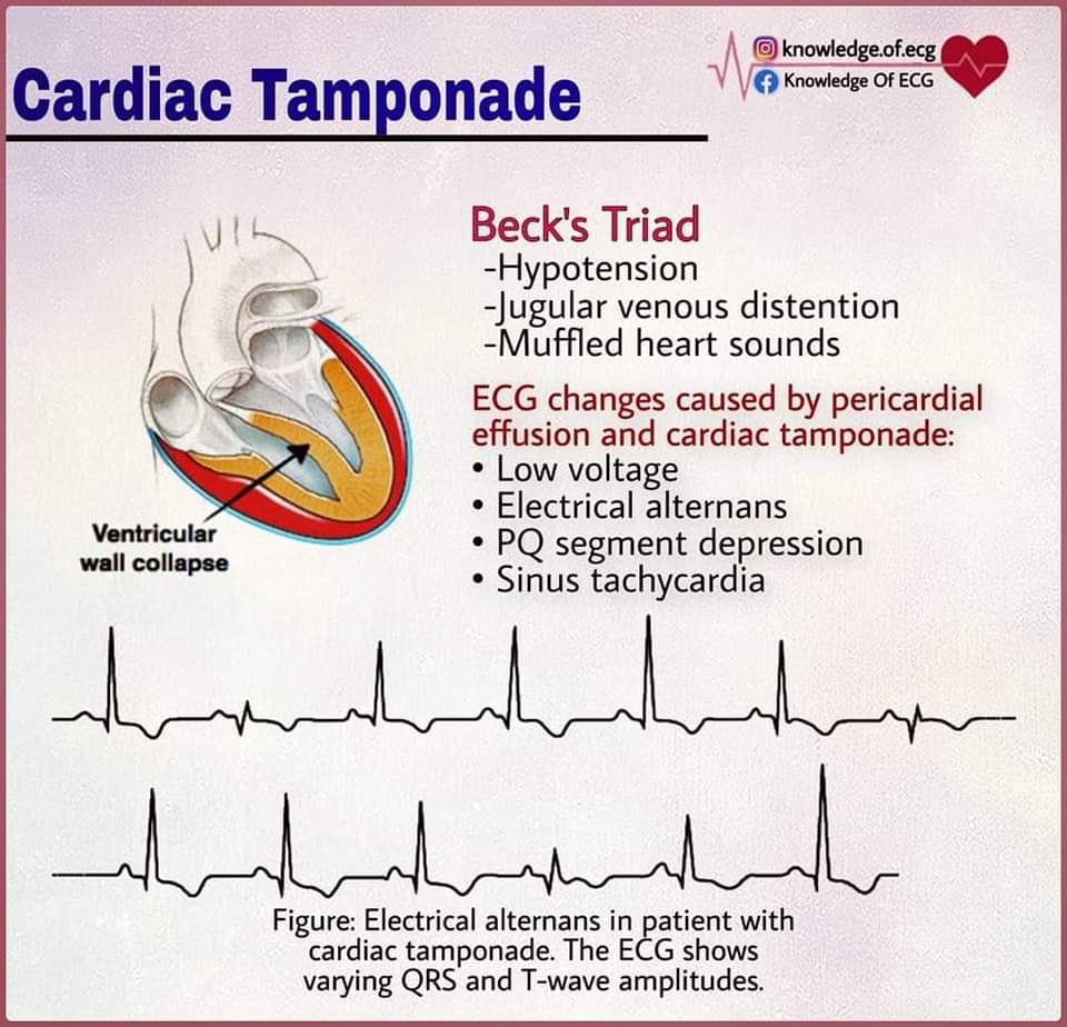 Cardiac Tamponade Ecg Electrocardiographic Changes In Patients With
