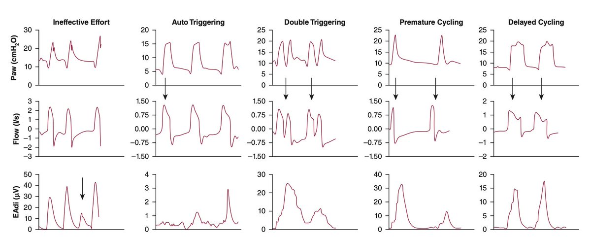 Noninvasive ventilation (NIV) has been standard of care treatment for ...