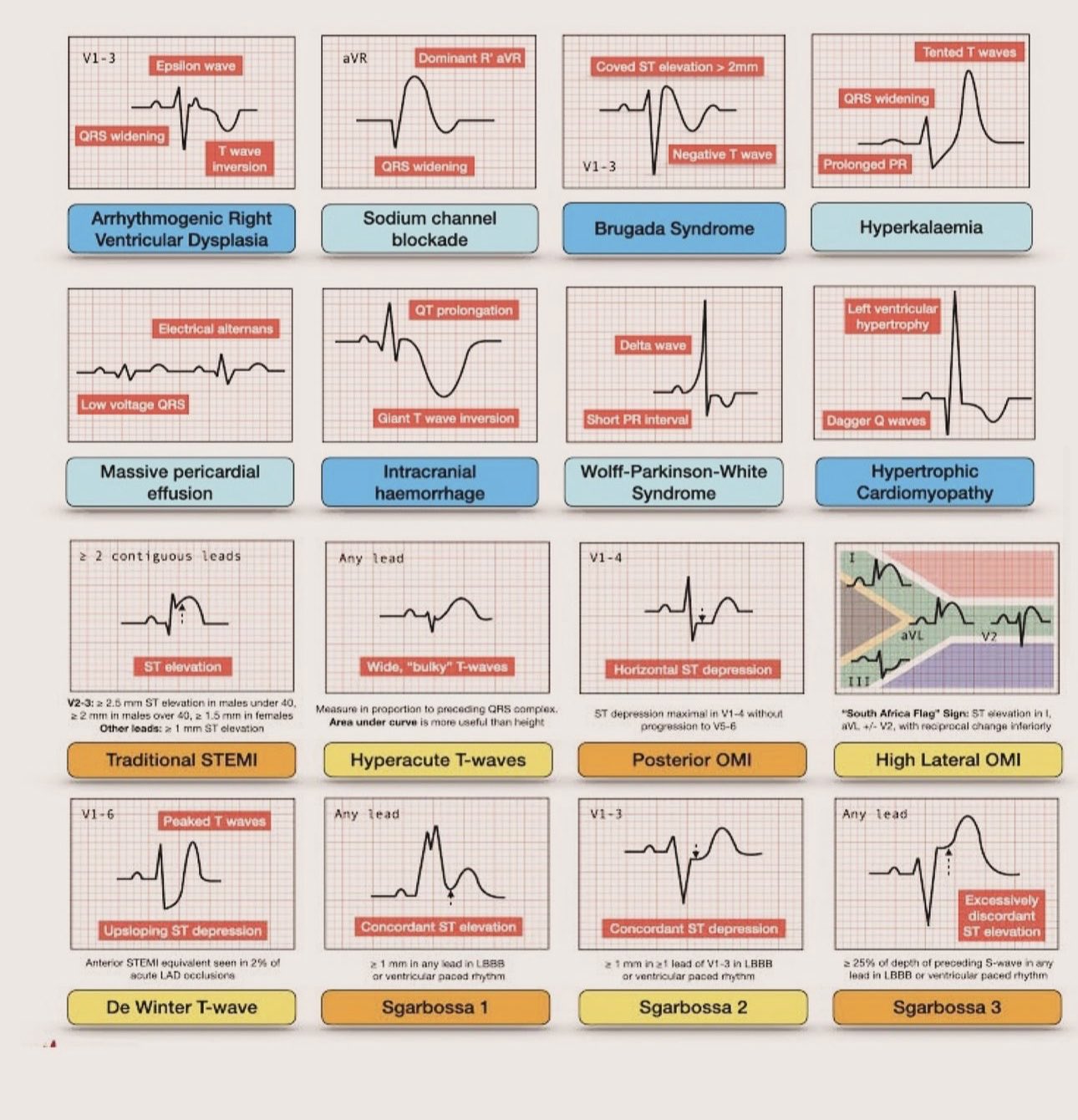 Bad Ekg Arrhythmia Wikipedia