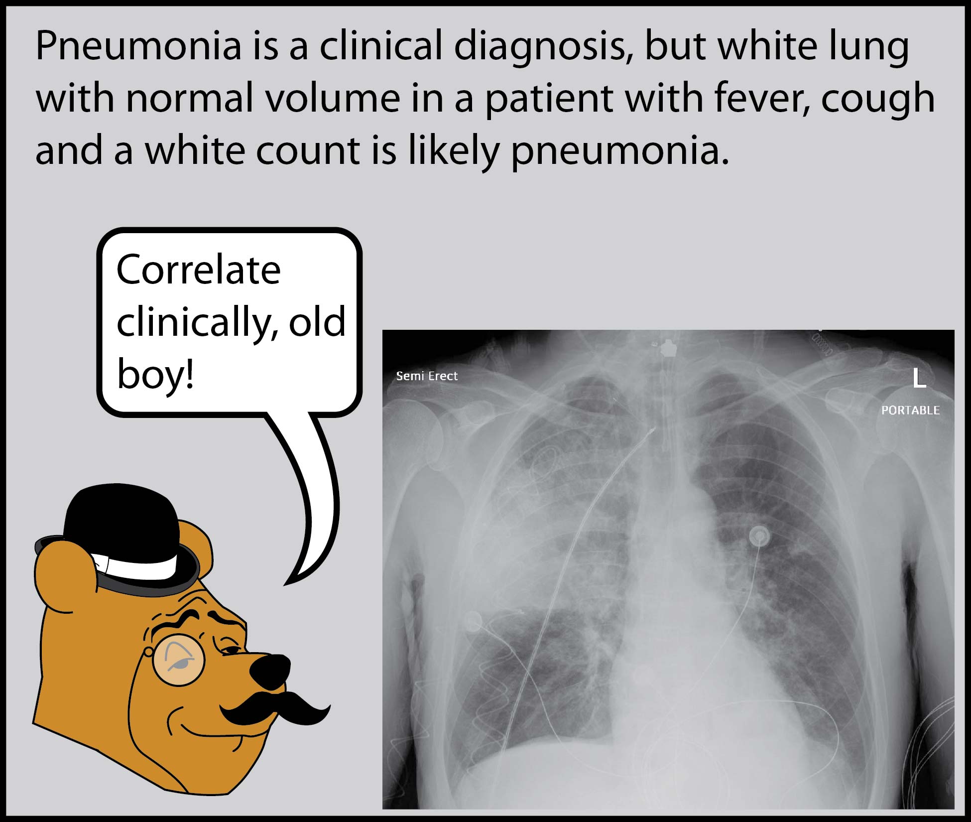 Funny Pneumonia Quotes How Advanced Is The Pneumonia? It's Taking