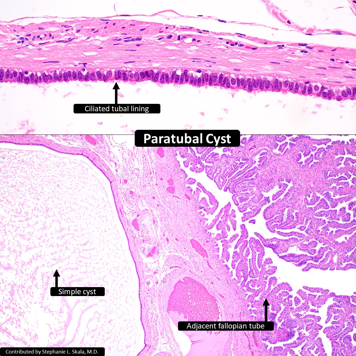 Fallopian Tube Cyst Pathology Outlines
