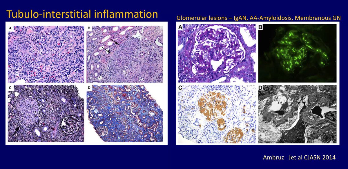 Summary of Non–Drug-Related Interstitial Nephritis #nephSAP 🧵 - Thread ...