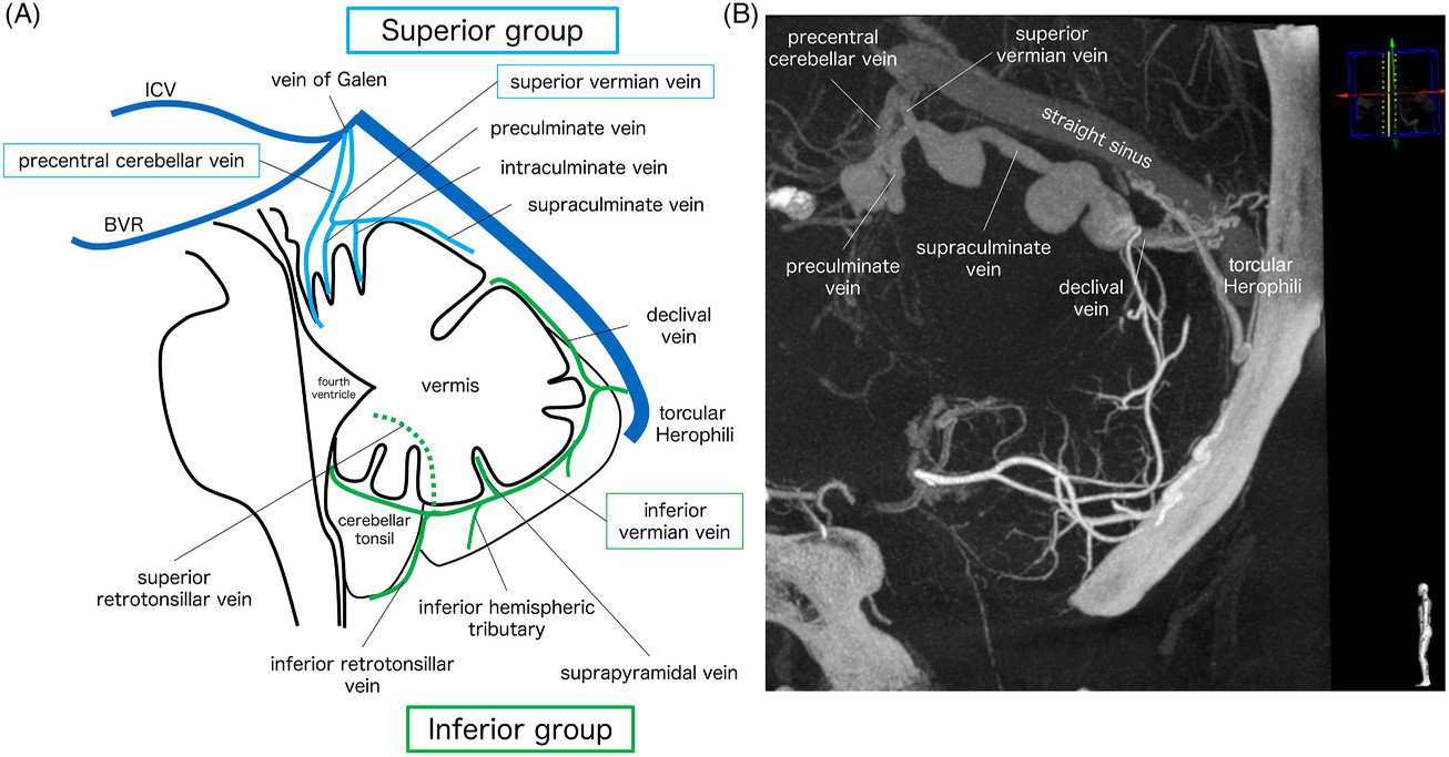 Fossa De Vermicompostagem Veins Posterior Fossa | Neuroangio.org