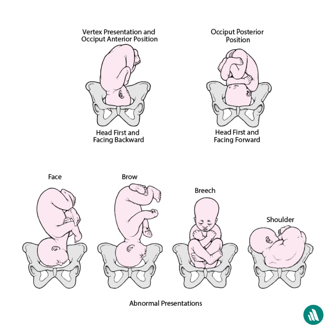 Vertex Presentation Normal Labor, Delivery, And Postpartum Care