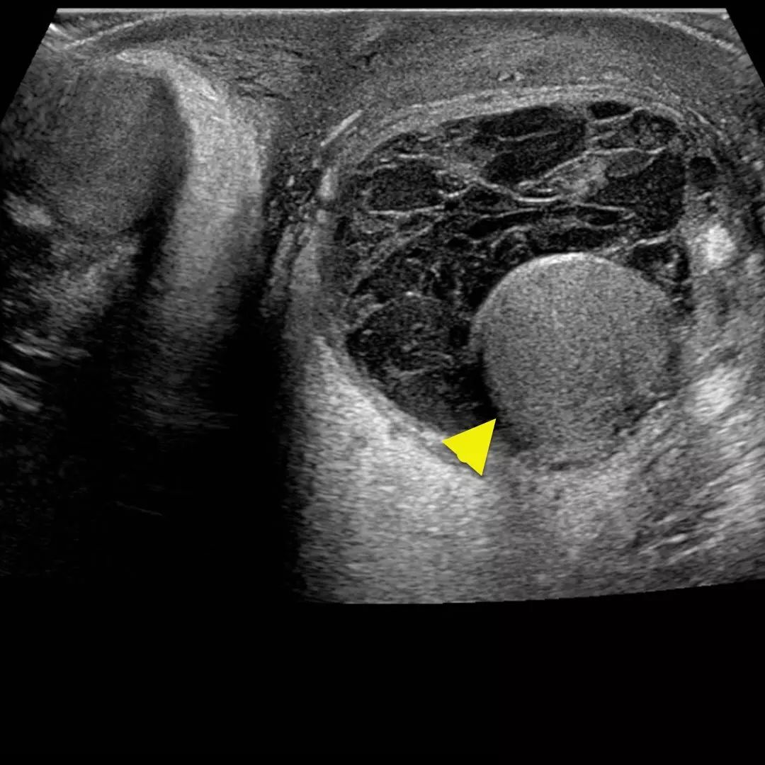 Epididymal Cyst Ultrasound
