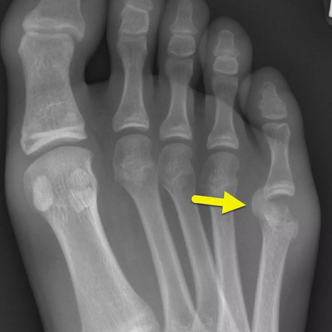 Metatarsal Head Fracture