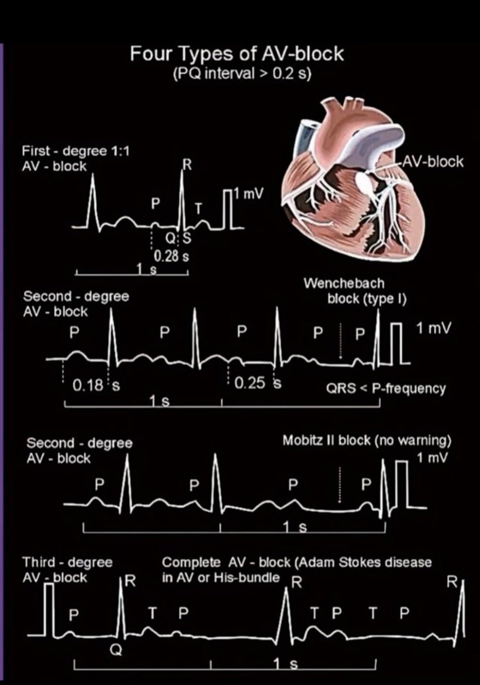 Different Types Of Heart Blocks ECG Learning Center An Introduction