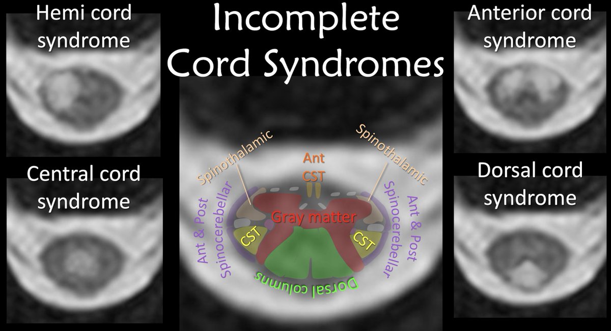 1/”I LOVE spinal cord syndromes!” is a phrase that has NEVER, EVER been ...