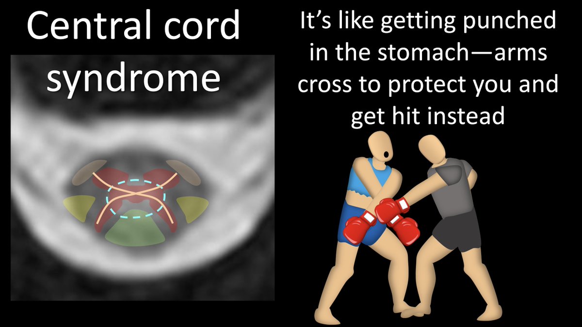 1/”I LOVE spinal cord syndromes!” is a phrase that has NEVER, EVER been ...