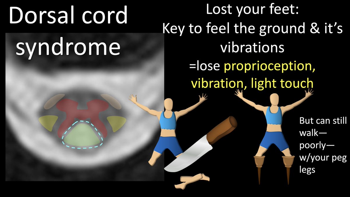 1/”I LOVE spinal cord syndromes!” is a phrase that has NEVER, EVER been ...