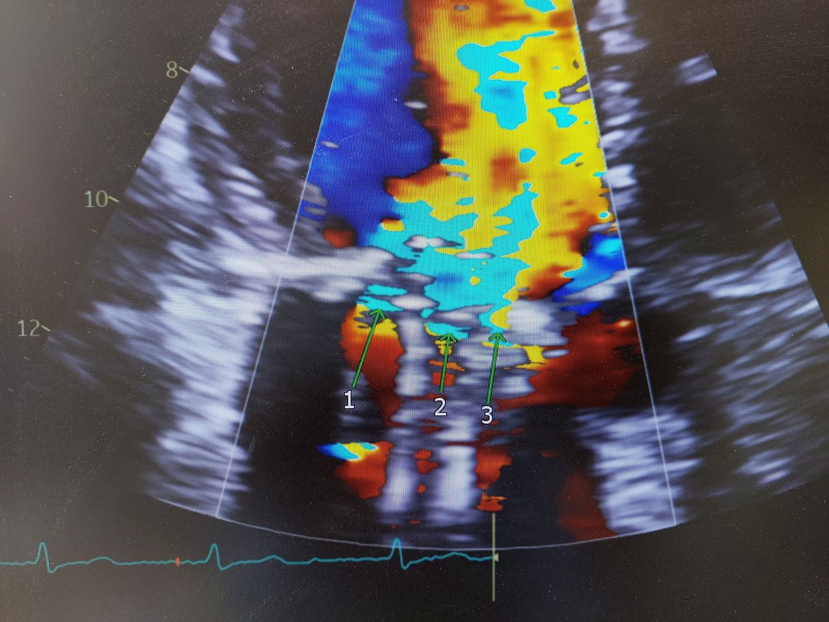 Echocardiography of mechanical mitral valves - A Visual Summary # ...