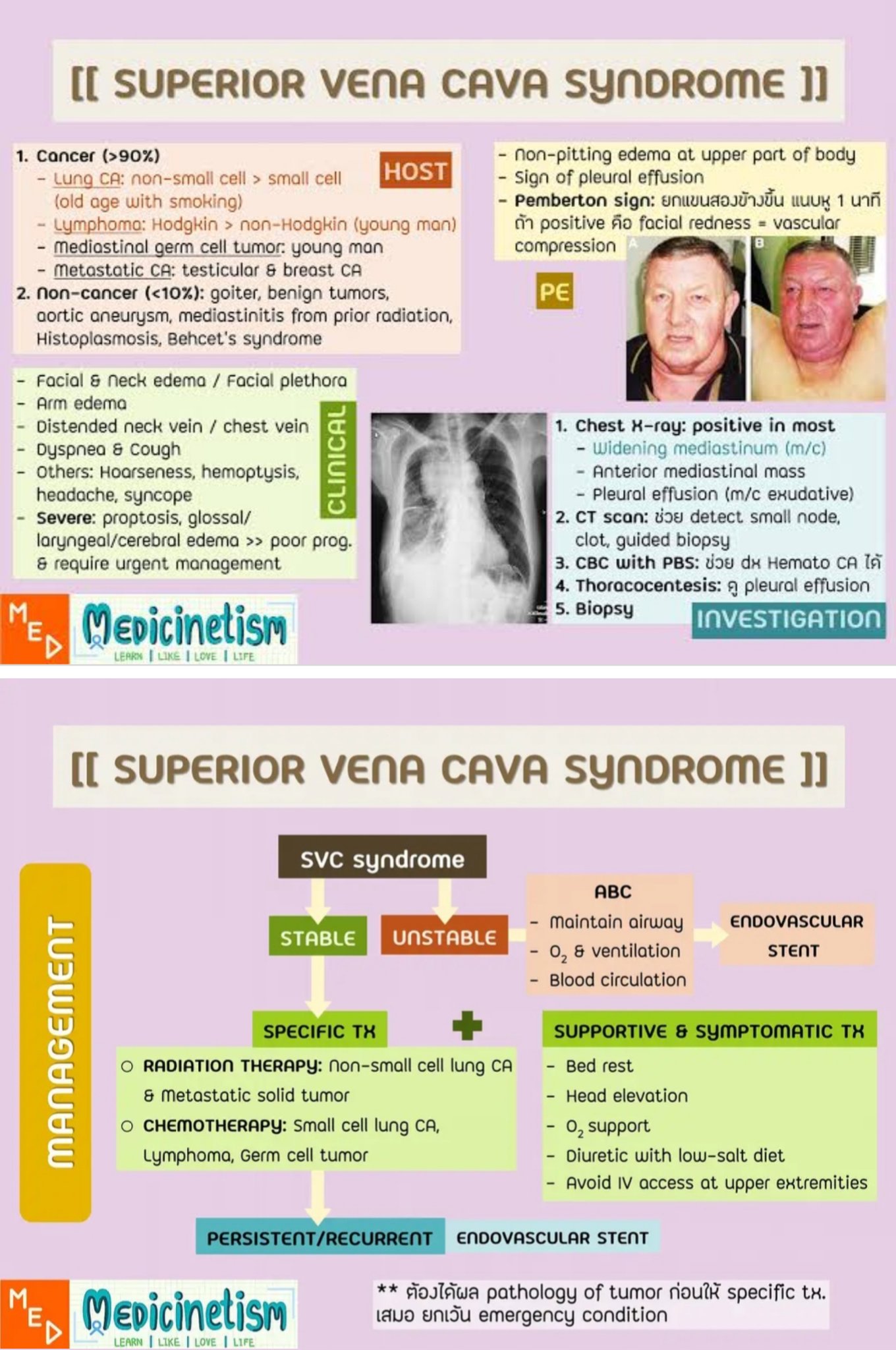 Superior Vena Cava Syndrome Pathophysiology