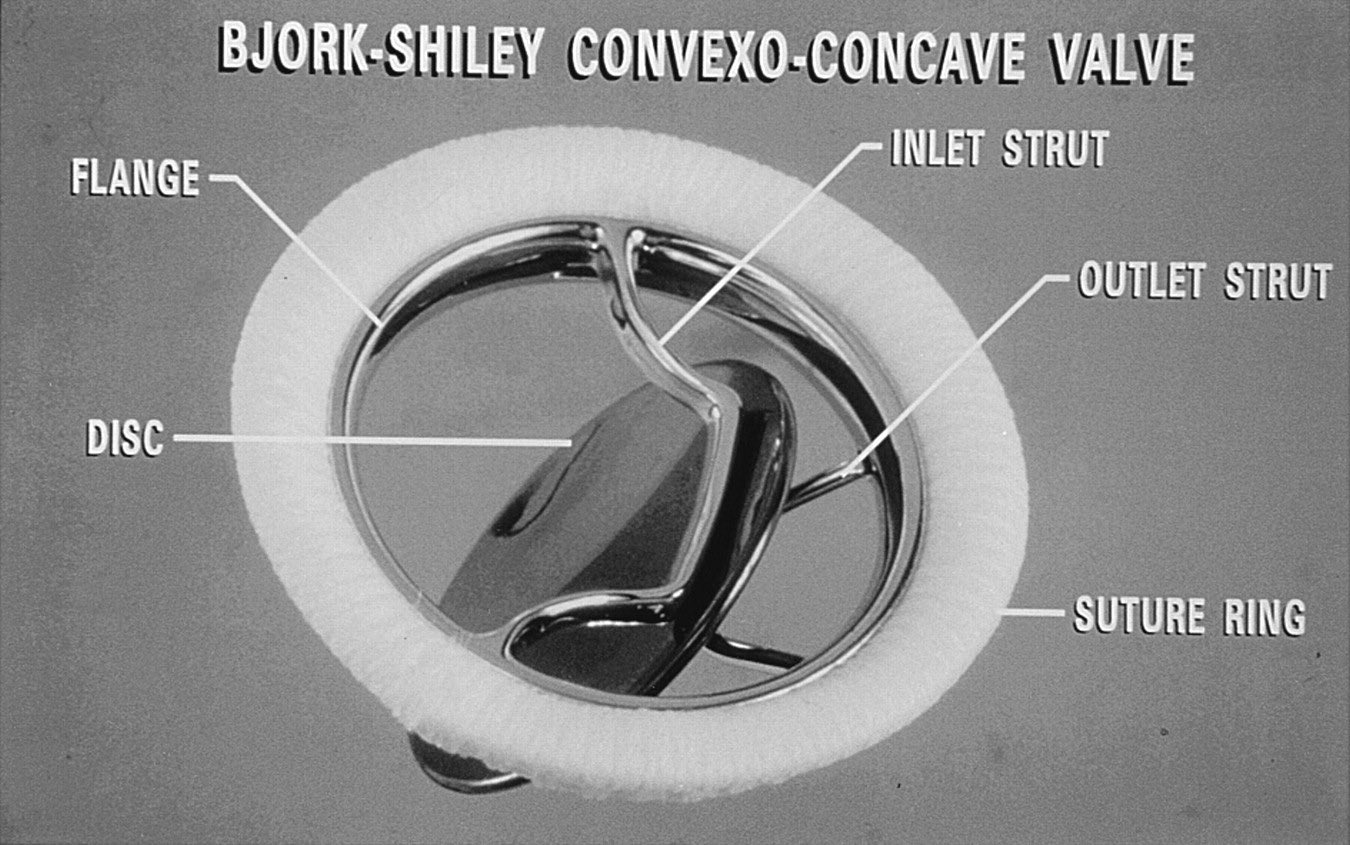 Aortic Valve Wikipedia The Natural History Of Bicuspid Aortic Valve