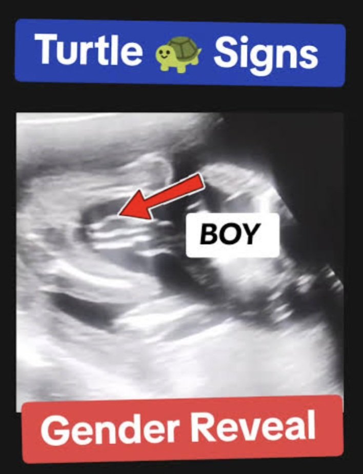 Turtle Sign Ultrasound