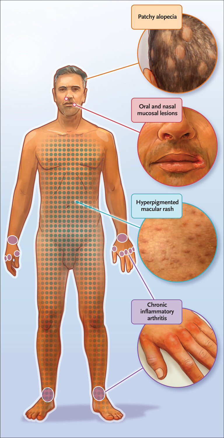 Syphilis Maculopapular Rash Periostitis In Secondary Syphilis