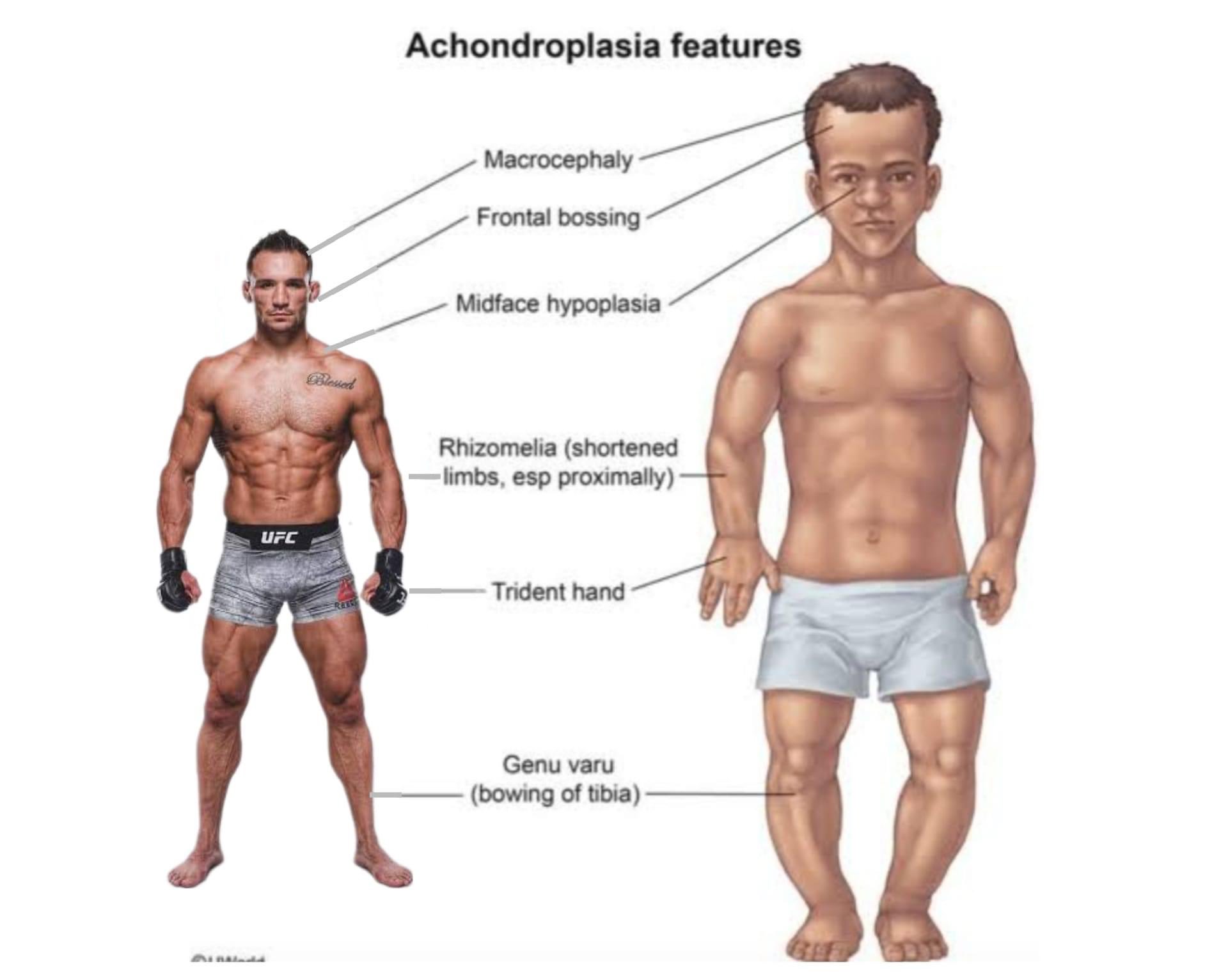 Achondroplasia Dwarfism Diagrams Even Though I Have Dwarfism Myself, I