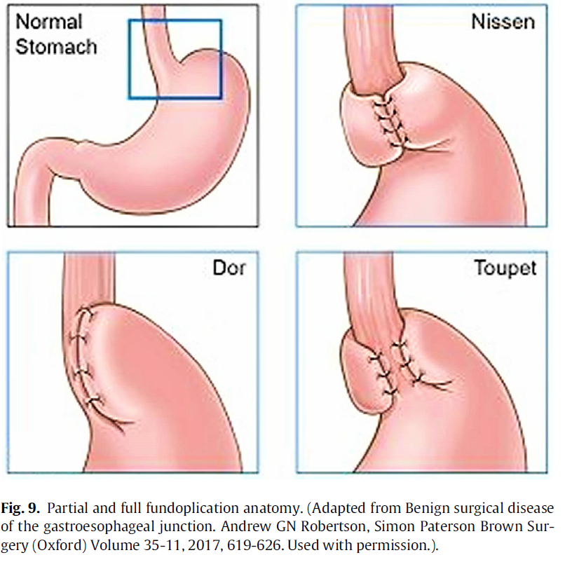 Fundoplicatura De Toupet FUNDOPLICADURA E OUTRAS TÉCNICAS NO MANEJO