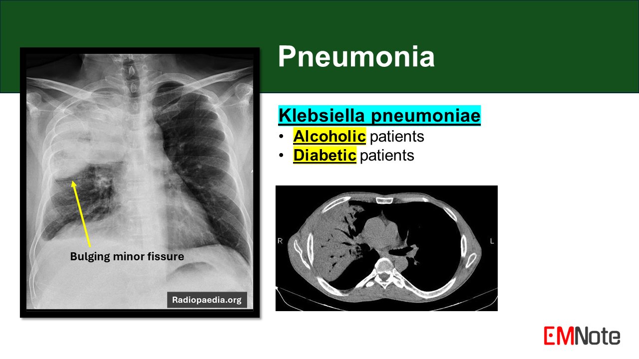 Bulging Fissure Sign The Radiology Assistant : Chest X Ray Lung