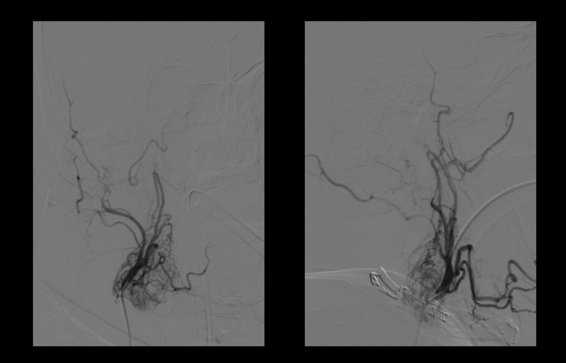 CV Section - AANS/CNS Cerebrovascular Section