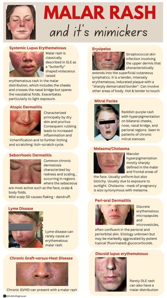 Causes Of Butterfly Rash Lupus Rash Under The Breasts: Pictures,