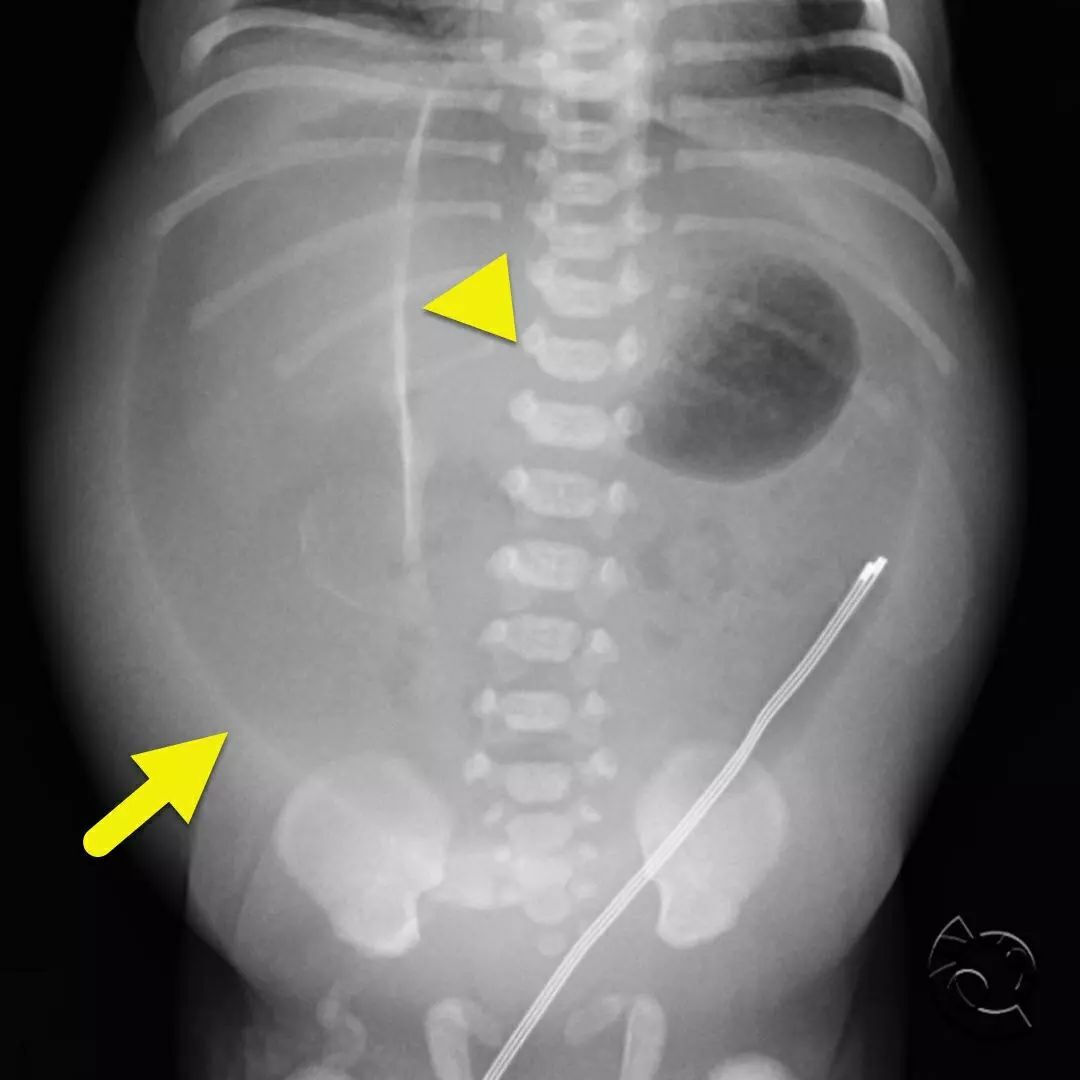 Falciform Ligament Ultrasound Round Ligament Varices Mimicking
