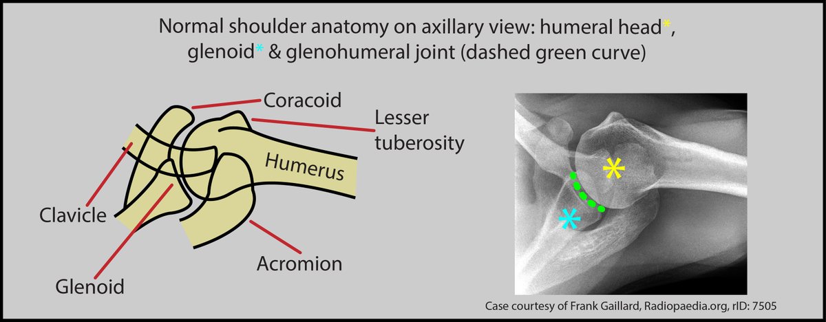 Axial Shoulder Anatomy Anatomically Labelled AP Shoulder X Ray.