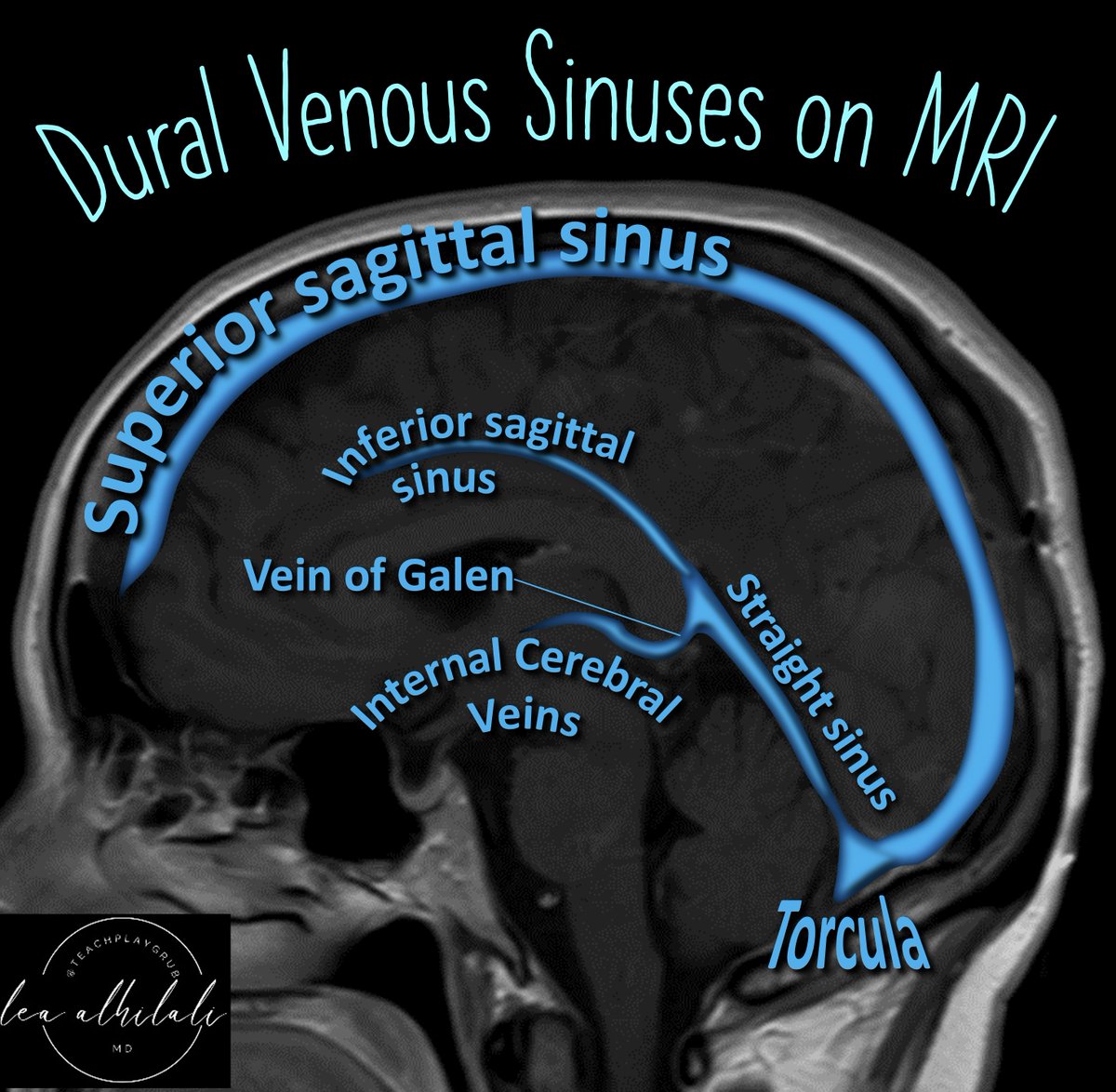 Venous Sinuses Anatomy Cerebral Venous Thrombosis – Core EM