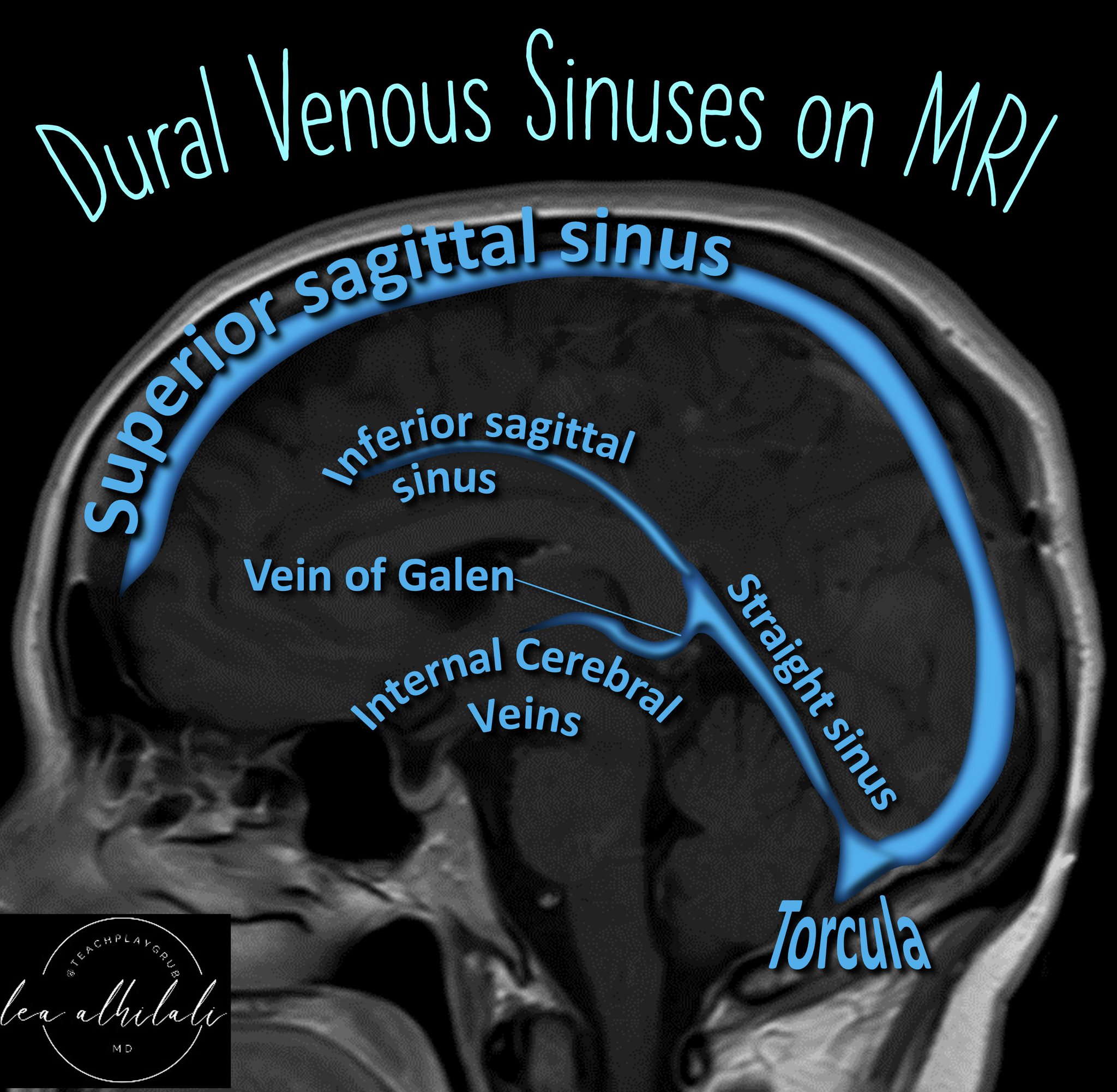 Venous Sinus Anatomy