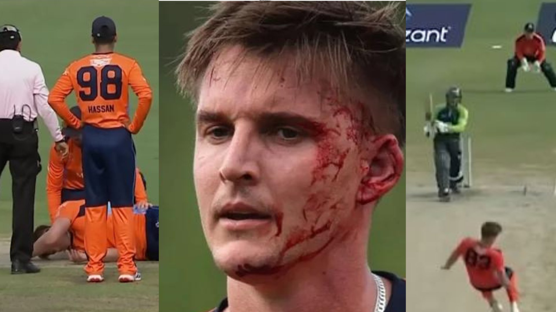 Sports Head Injury Hematoma Second Impact Syndrome | Symptoms,