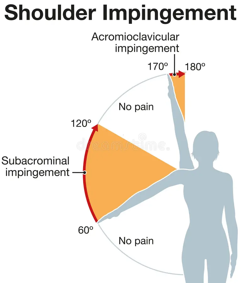 Shoulder Impingement is the worlds most common shoulder injury. 50% of ...