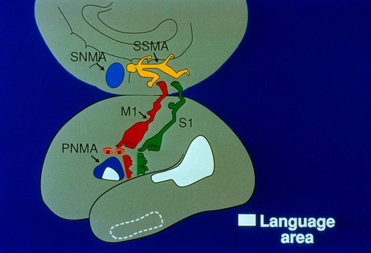 SEIZURE SEMIOLOGY #TWEETORIAL #Epilepsy #Seizure #NeuroX 🧵1/ What is a ...