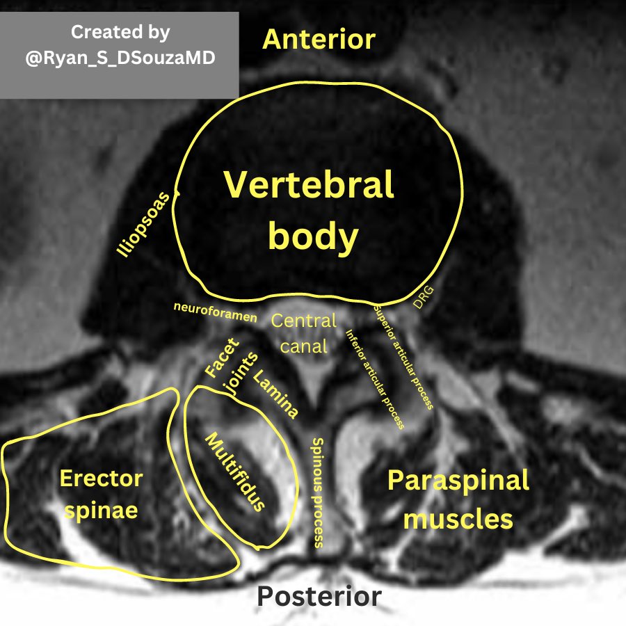 Lumbar Spine Mri Axial Explaining Spinal Disorders: Lumbar Spinal