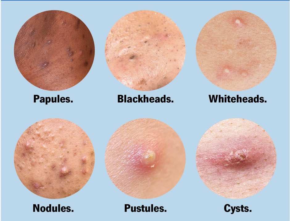 ACNE Acne is described as the 8th most common disease worldwide ...