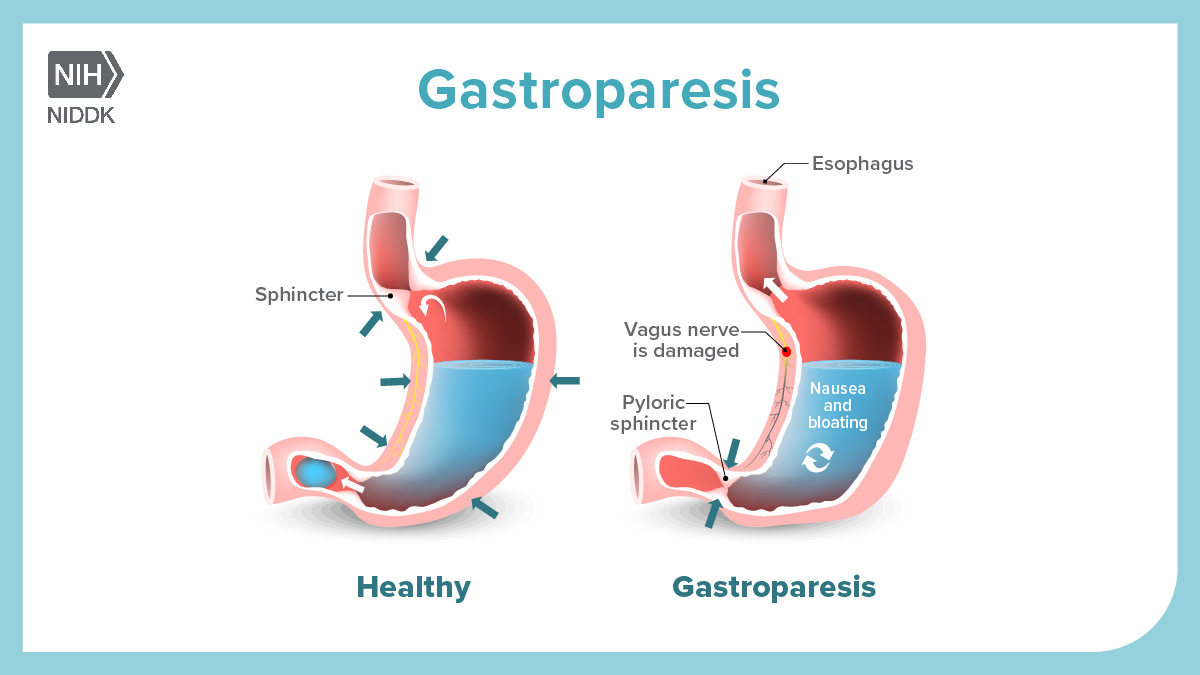 Gastroparesis là gì? Tìm hiểu về bệnh lý dạ dày và cách điều trị hiệu quả