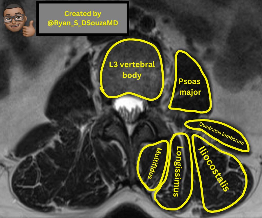 Lumbar Paraspinal Muscles Anatomy Muscles Of The Lumbar Spine Of The