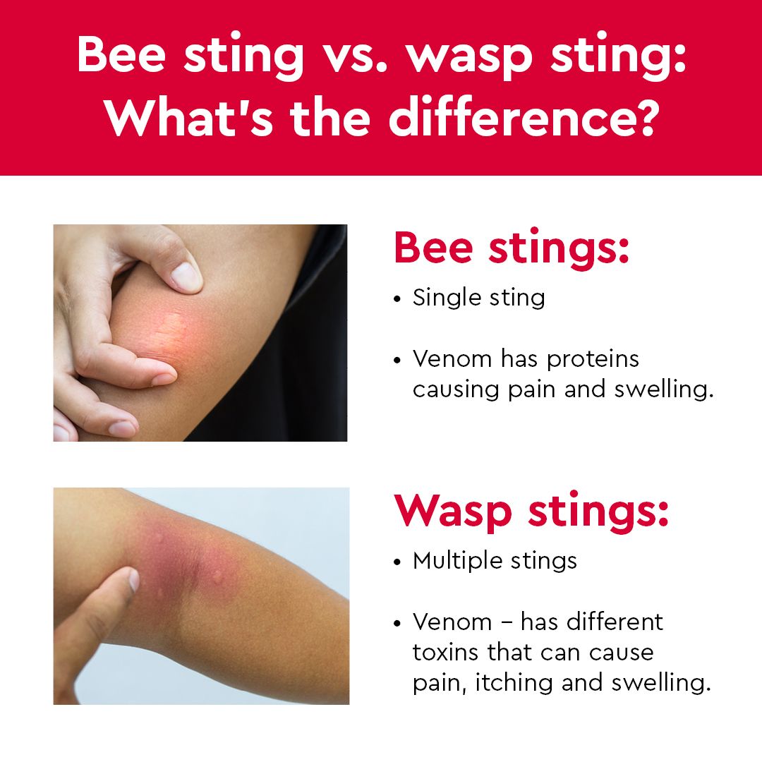 Normal Wasp Sting Reaction