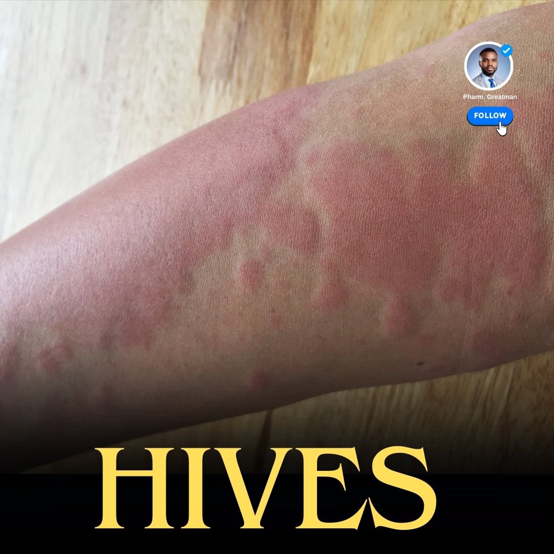 Have you ever had red, itchy swellings on your skin before? 🤔 It could ...