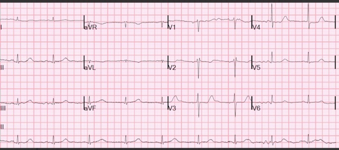 ECG features of hypokalaemia U waves small or absent T waves ...